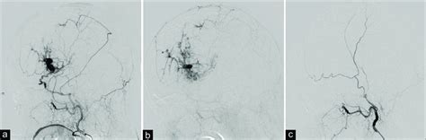 Cerebral Angiogram On Admission And After Preoperative Embolization Download Scientific
