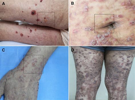 Nodular Scabies