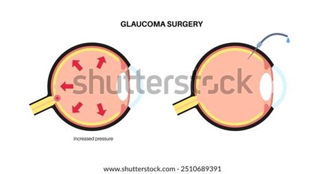 Glaucoma Surgery Concept Reduce Intraocular Pressure Stock Vector