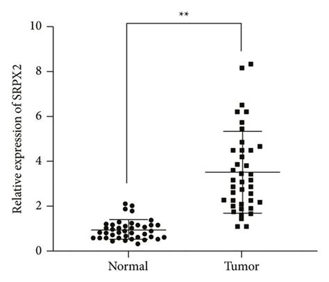 srpx2 is elevated in ptc a srpx2 expression in ptc cells b srpx2