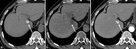 Dual Energy Computed Tomography Of The Abdomen A Reliable Trouble