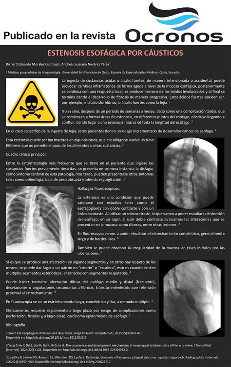Póster Estenosis Esofágica Por Cáusticos Ocronos Editorial