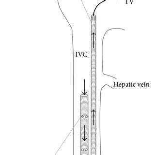 Cannulation Options In Vv Ecmo A Femorojugular Configuration B