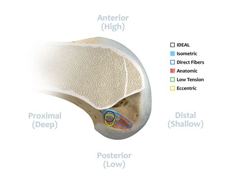 I D E A L Femoral Tunnel Location With Biomet Sports Medicine