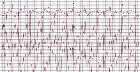 Genetics And Arrhythmias Diagnostic And Prognostic Applications
