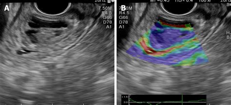 Extrahepatic Cholangiocarcinoma Current Status Of Endoscopic Approach
