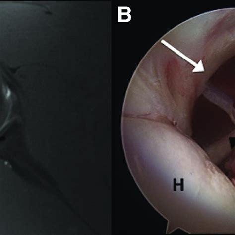 Right Shoulder Magnetic Resonance Arthrogram And Corresponding Download Scientific Diagram