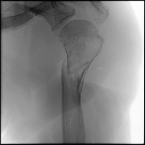 Preview Fracture Of Proximal Humerus Left