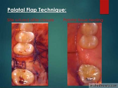 Maxillary Sinus Disease Pptx دوفاء Muhadharaty