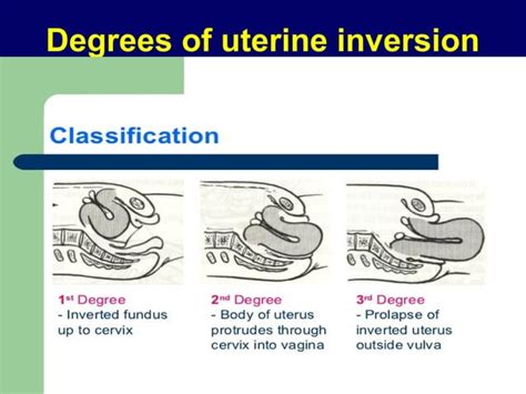 Retroverted Retroflexed Uterus Anduterine Inversion