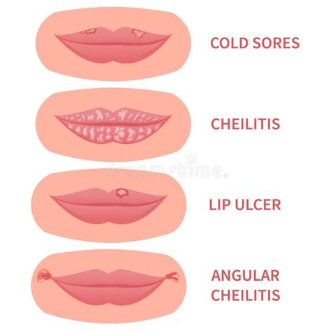 Cheilitis Stock Illustrations 14 Cheilitis Stock Illustrations
