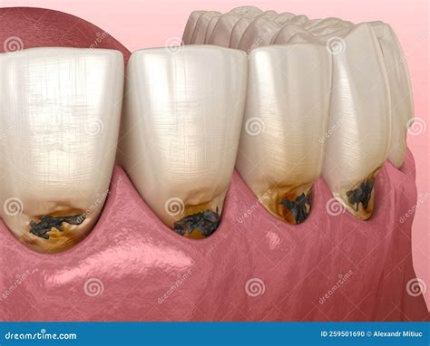 Cervical Caries On Frontal Teeth Medically Accurate Tooth 3d