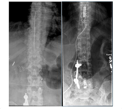 Examples Of Percutaneous Scs Leads Left And Paddle Scs Leads Right