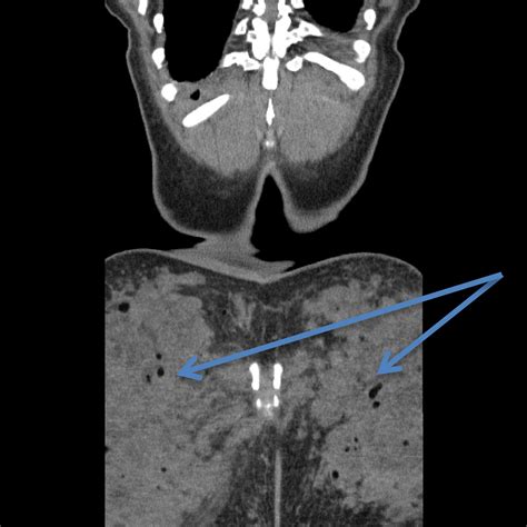 Silicone Injectionrelated Granulomatous Hypercalcemia The American