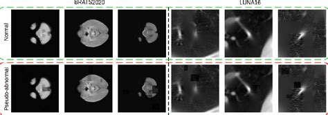 Figure From Masked Autoencoders For Unsupervised Anomaly Detection In Medical Images