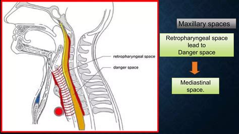 Fatal Complications Of Maxillofacial Infection Ppt