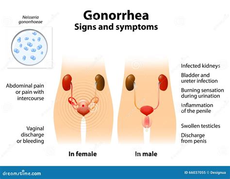 Gonorrhea Or Gonnococcal Infection Stock Vector Illustration Of Neisseria Burning
