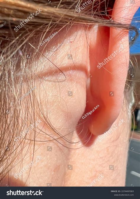 Why Do I Have A Lymph Node Behind My Ear