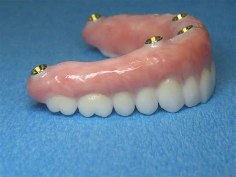 Dental Implant Overdenture Locator Attachmentspatient Information
