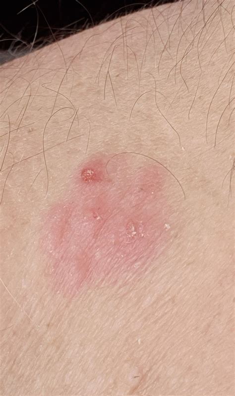 One Shingles Spot On Arm