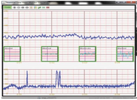 Exam 2 Fhr Monitoring W3 Learning Guide Flashcards Quizlet