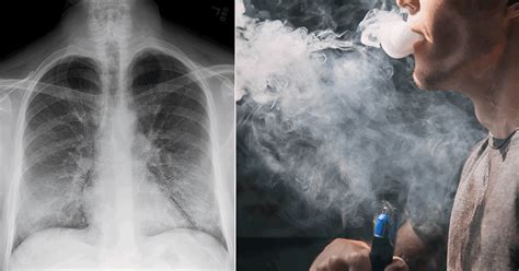 Vapings Hidden Damage How Flavors Mask Lung Disease Engineerine