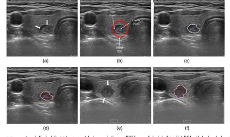 Thyroid Nodule Ultrasound