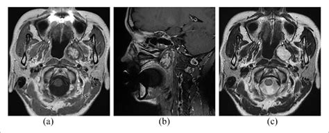 Mri Before The Operation Showed The Well Defined Mass In The Left Pps Download Scientific