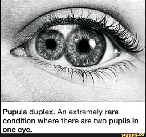 Two Pupils In One Eye