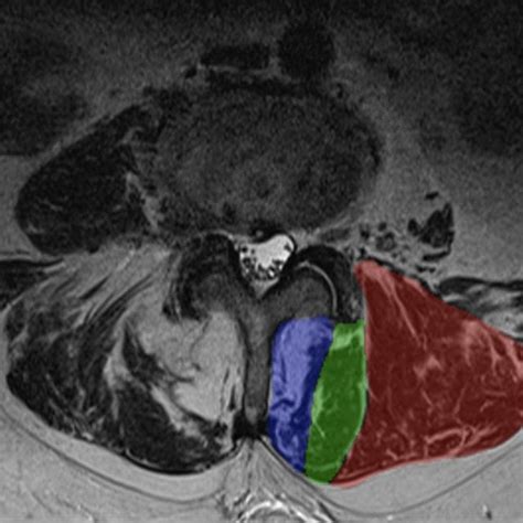 Manual Segmentation Definition Of The Voi Of The 3 Paraspinal Muscles