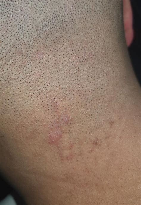 Anyone Help With This R Folliculitis