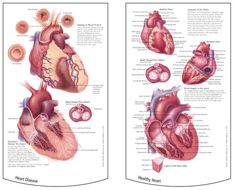 Unhealthy Heart Diagram