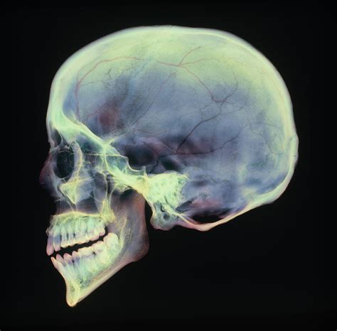 What Is Skull X Ray At Alonzo Caraway Blog