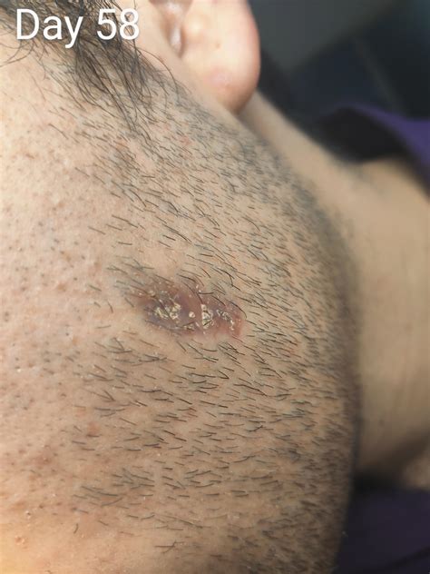 Am I Healing Correctly Mole Excision Day 58 Rplasticsurgery