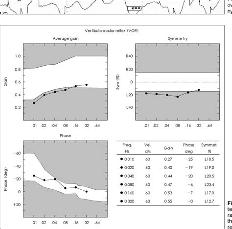 Figure 2 From Cerebellar Venous Angioma Confused With Peripheral Vestibulopathy Semantic Scholar