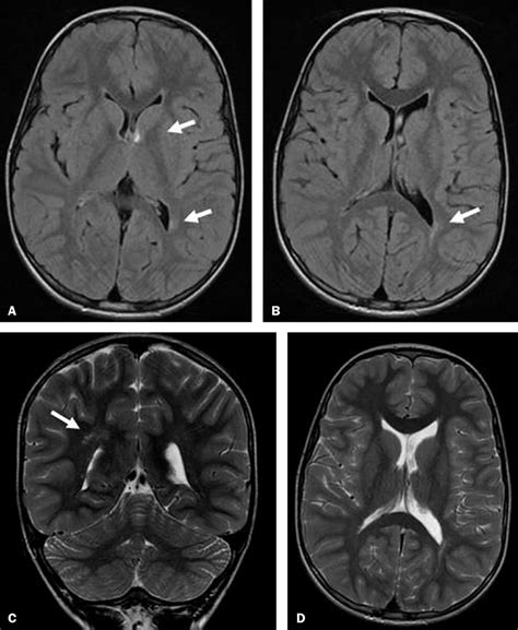 Ventricles Of The Brain Mri