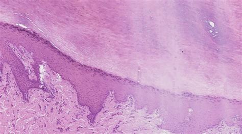 Punctate Palmoplantar Keratoderma