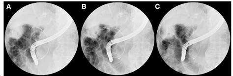 Subtype α2 Of Cystic Duct Became The Subtype Line One Using The