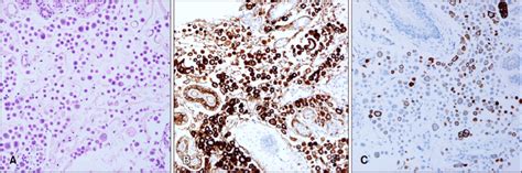 A Histopathological Examination Revealing Diffuse Infiltration With Download Scientific