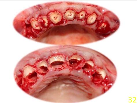 Partial Extraction Therapy Abdulsalam Alrmali Prosthocontest2019