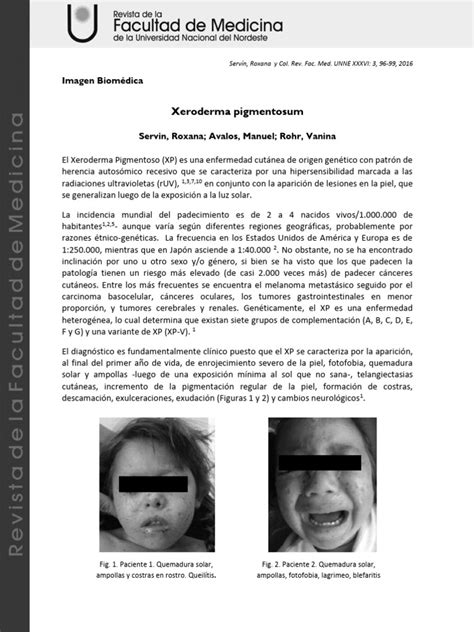 Xeroderma Pdf Cáncer Melanoma