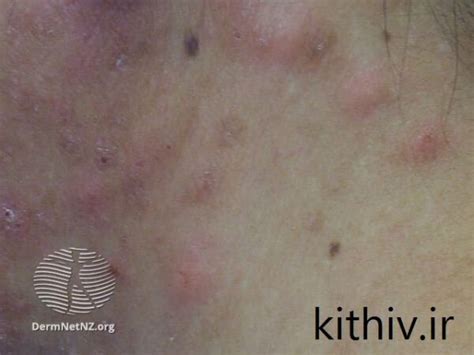 همه علائم پوستی ایدز همراه با عکس تصویر کیت Hiv