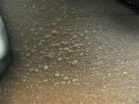 Erythema Toxicum Neonatorum Histology