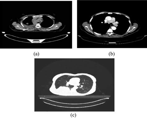 a median filter output of ct lung input image 1 b median filter