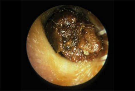 Patho Exam 4 Flashcards Quizlet