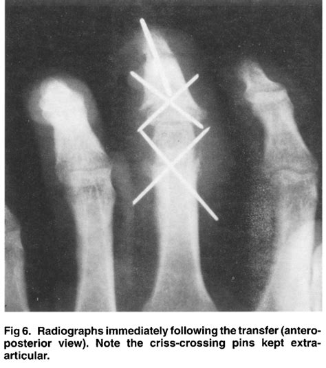 Percutaneous Fixation Of Metacarpal Fracture