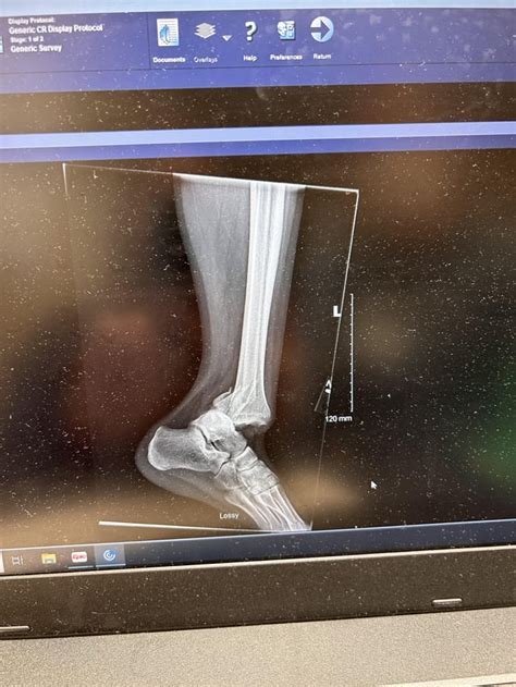 Trimalleolar Dislocation R Brokenbones