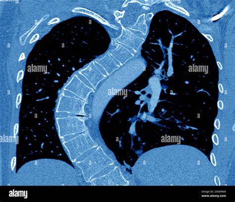Curvature Of The Spine Coloured Frontal Computed Tomography Ct Scan Of A Section Through The