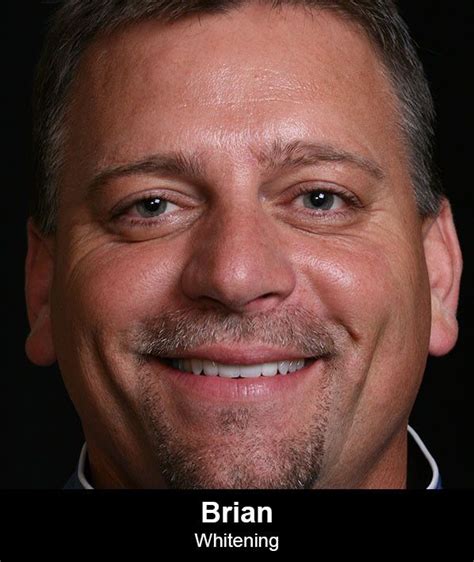 Whitening Gallery Teeth Transformations By Amy Norman Dds