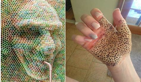 Trypophobia Skin Causes